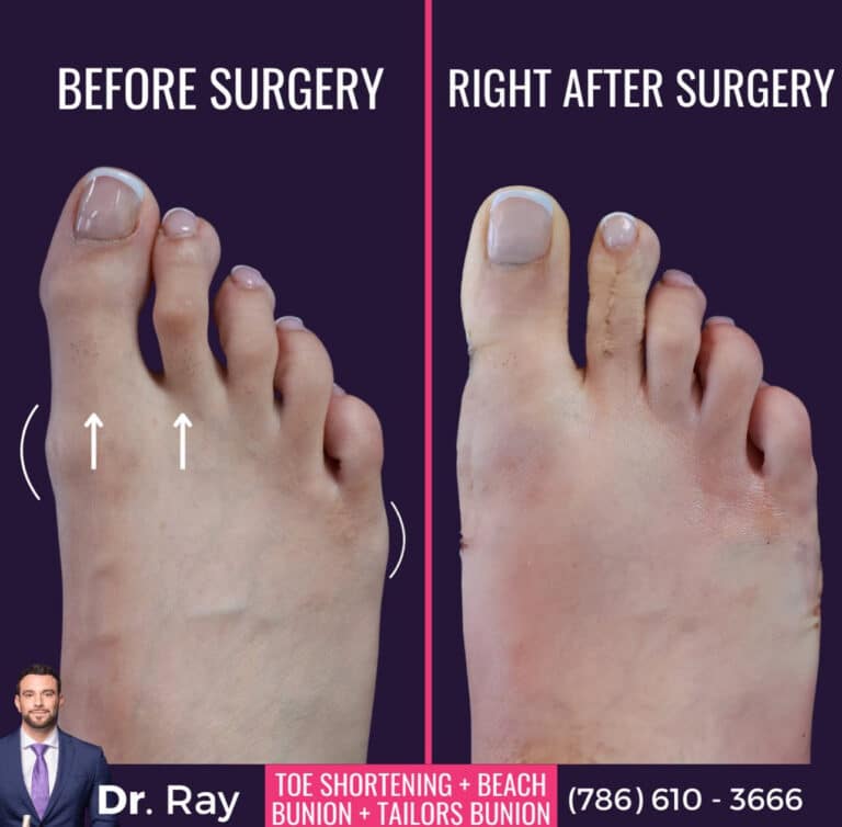 Toe Shortening Surgery: Everything You Need to Know