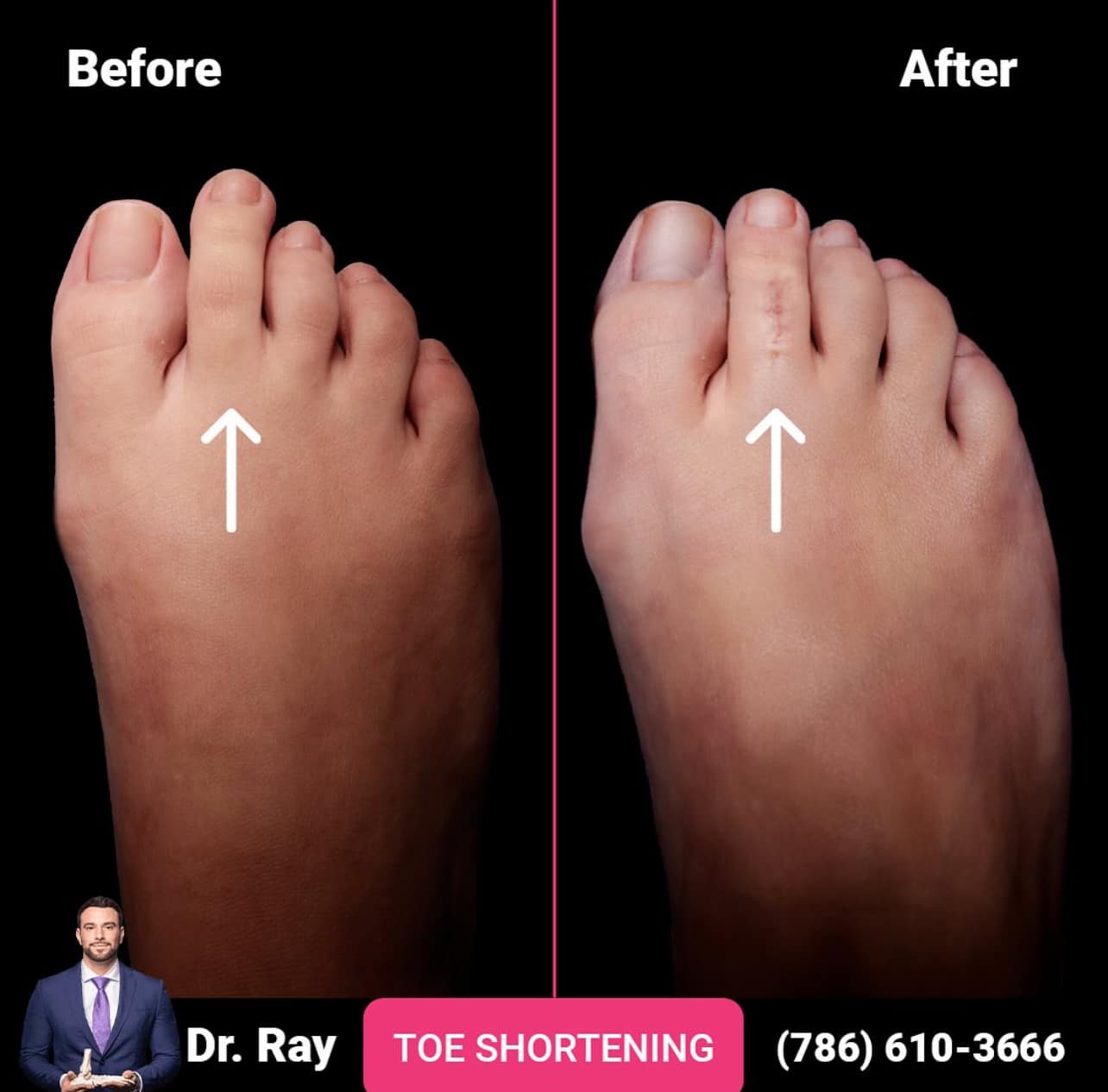 Toe Shortening Surgery: Everything You Need to Know