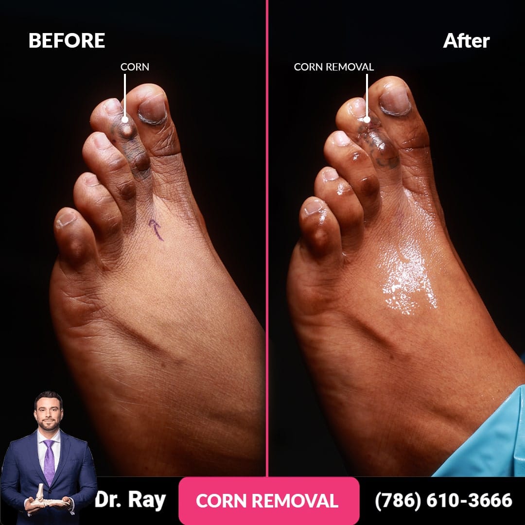 Corn Removal Surgery Before and After Photos - Luxe Foot Surgery