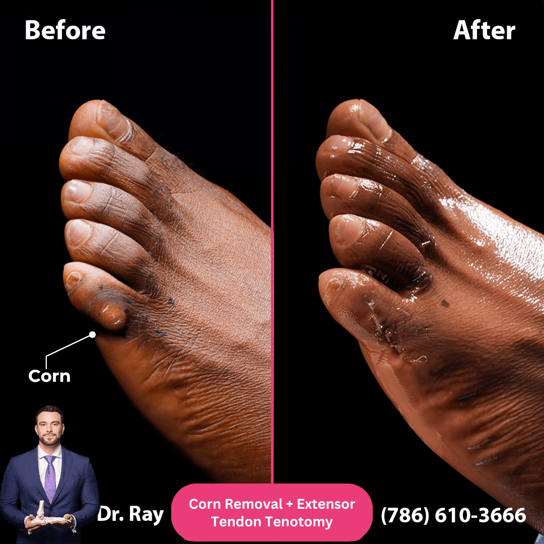 Corn Removal Surgery Before and After Photos - Luxe Foot Surgery