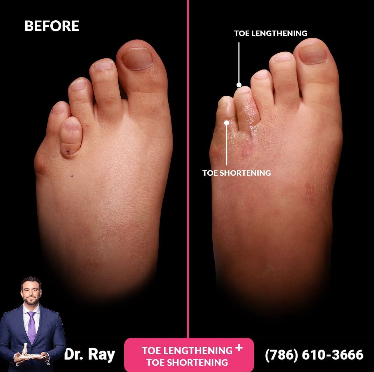 Minimally Invasive Surgery Specials - Luxe Foot Surgery