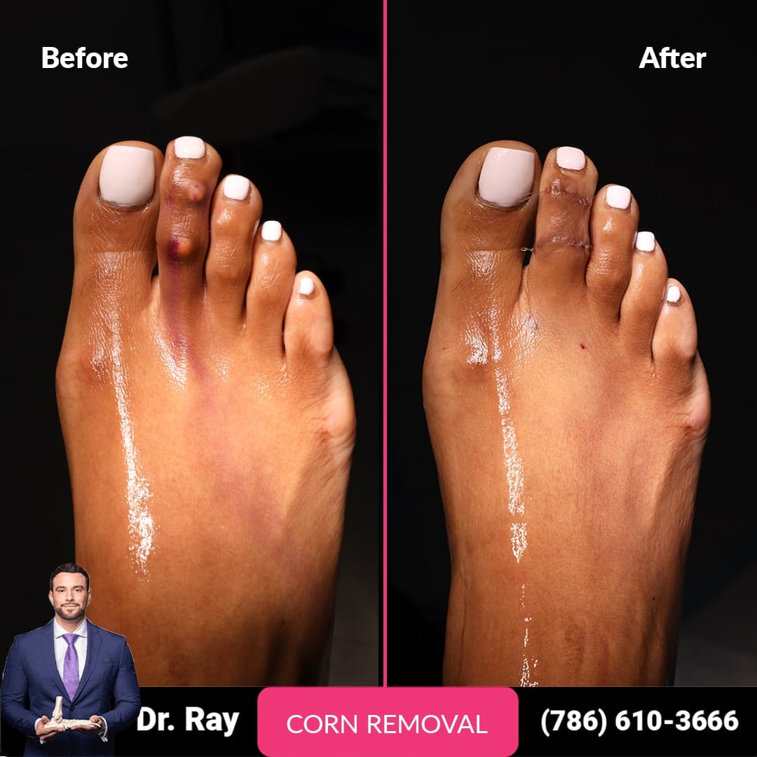 Corn Removal Surgery Before and After Photos - Luxe Foot Surgery