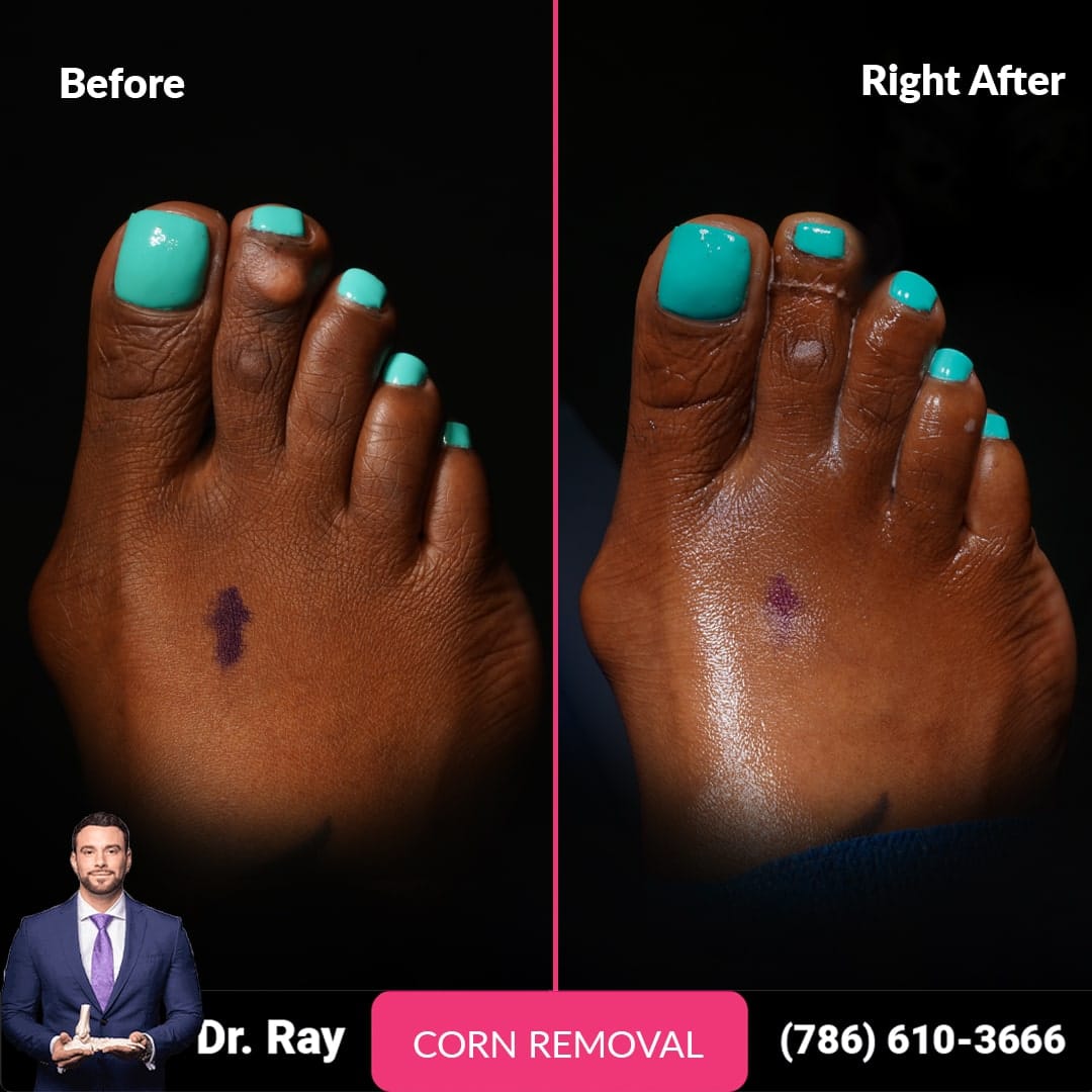 Corn Removal Surgery Before and After Photos - Luxe Foot Surgery