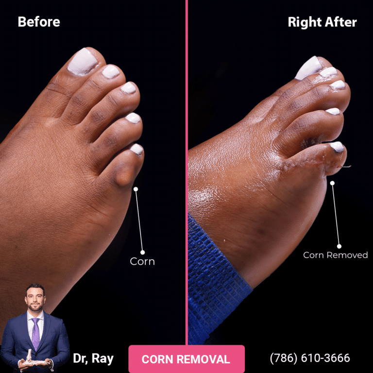 Corn Removal Surgery Before and After Photos - Luxe Foot Surgery