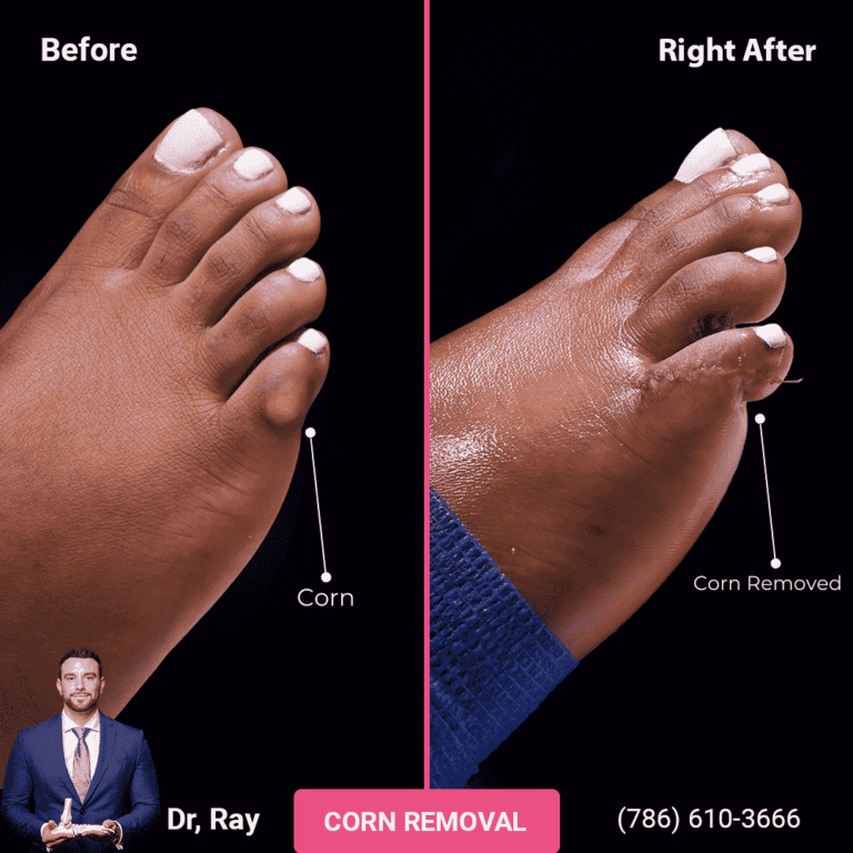 Permanent Callus and Corn Removal Surgery