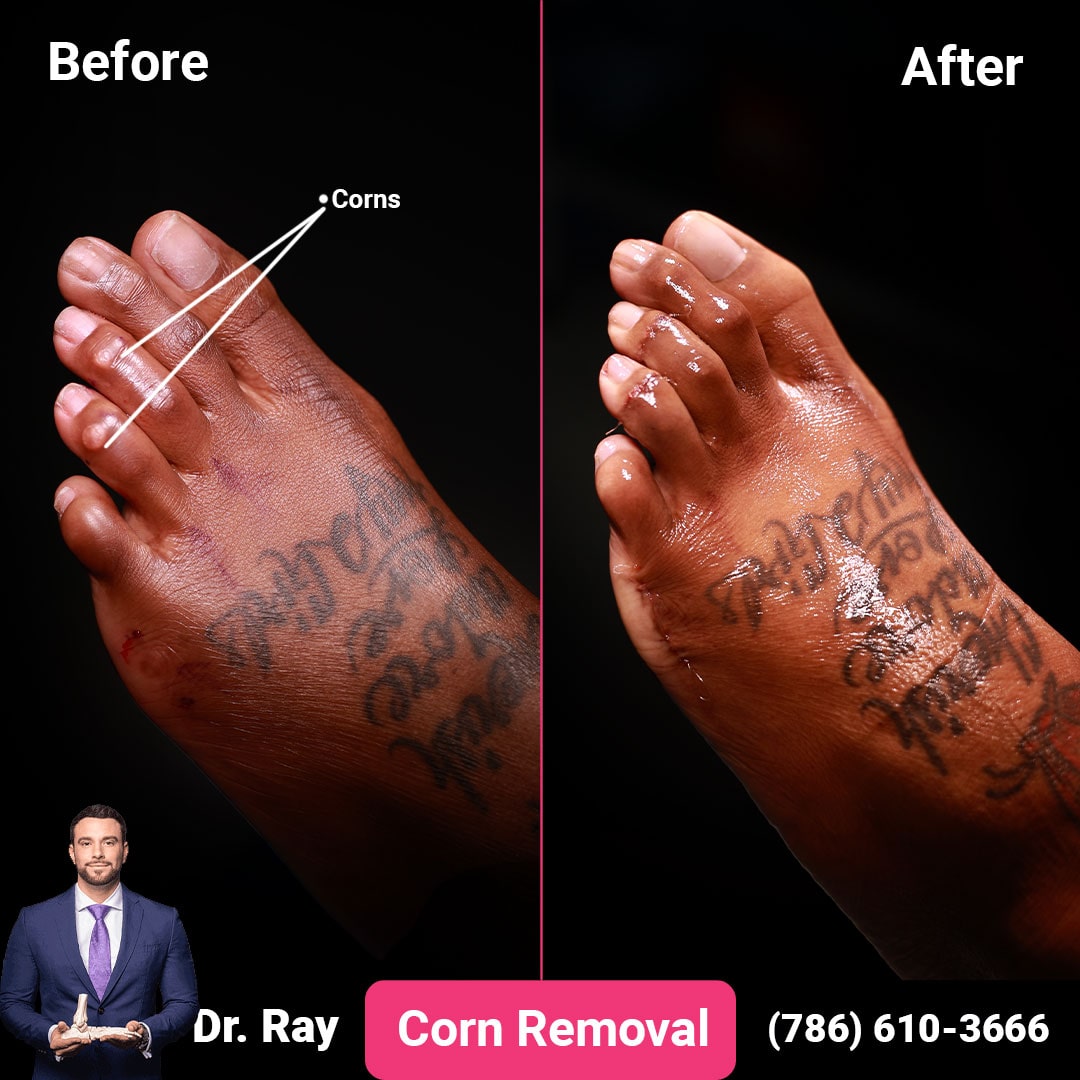 Permanent Callus and Corn Removal Surgery