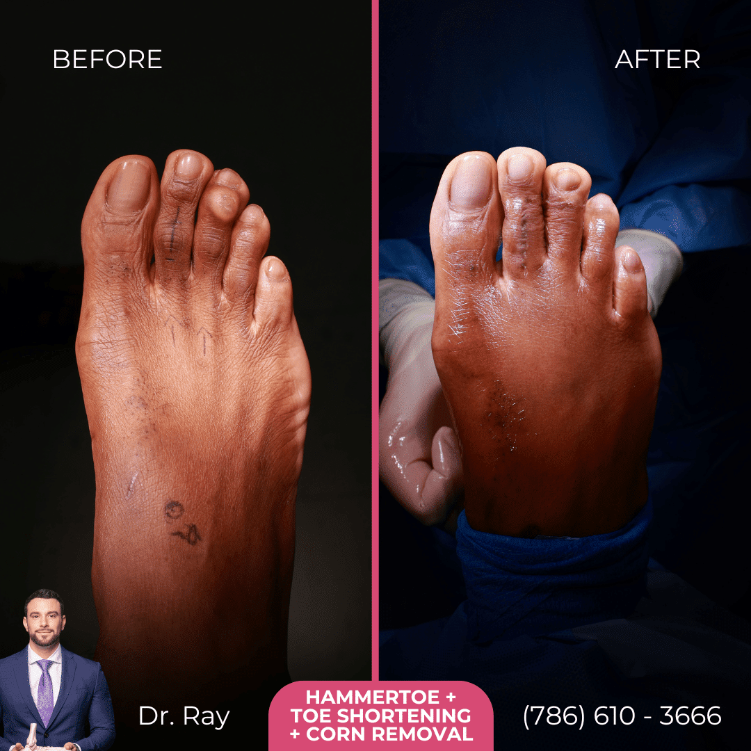 Corn Removal Surgery Before and After Photos - Luxe Foot Surgery