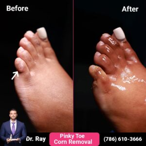 Permanent Callus and Corn Removal Surgery