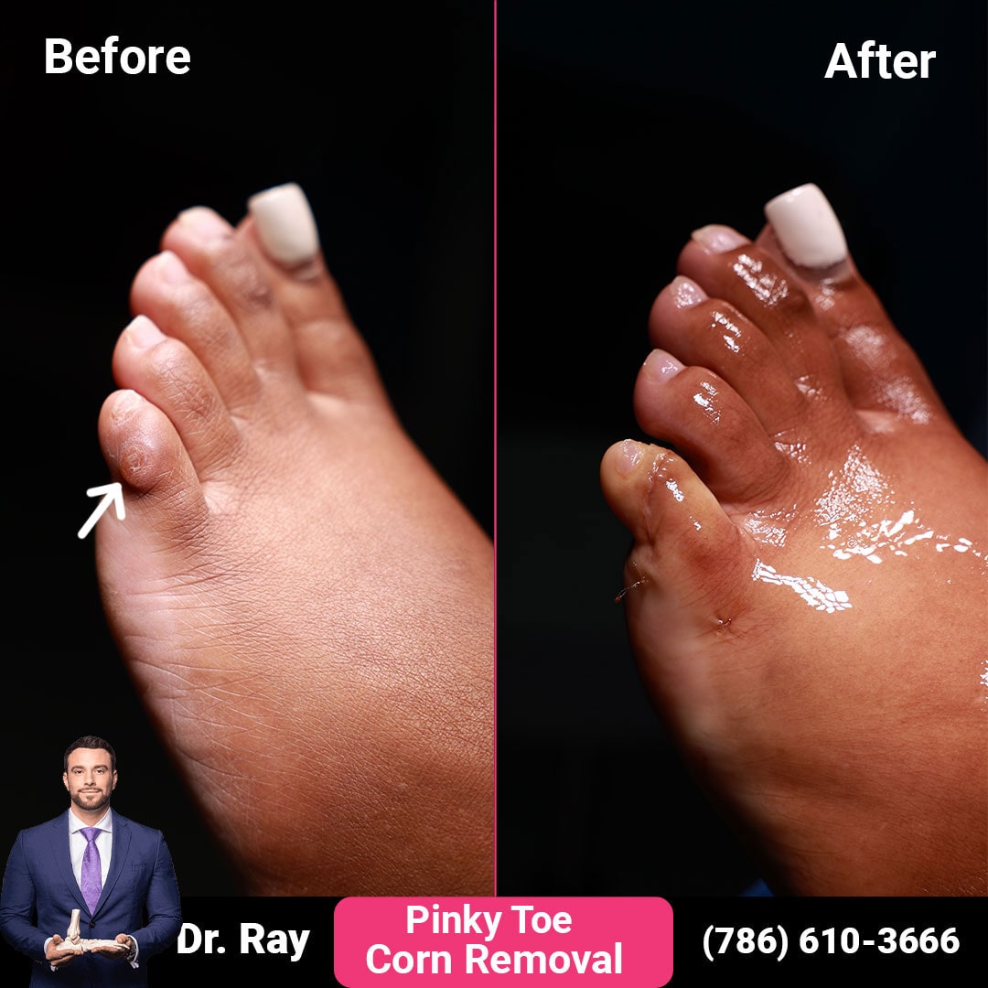 Corn Removal Surgery Before and After Photos - Luxe Foot Surgery