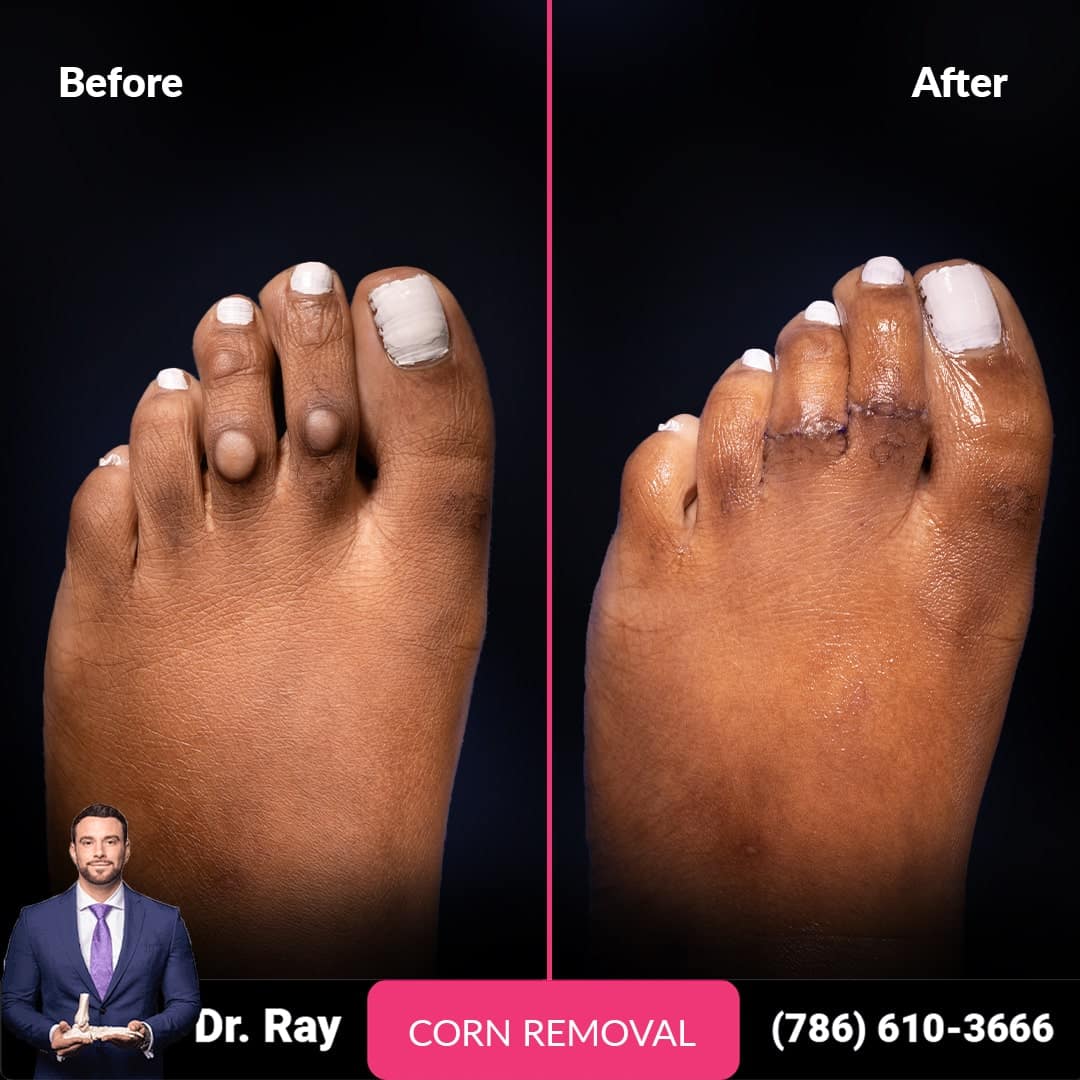 Permanent Callus and Corn Removal Surgery